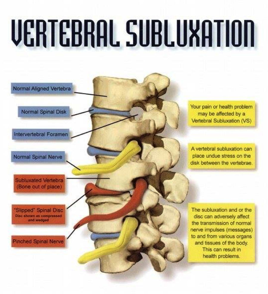 Is this a subluxation? I thought it was normal for my jaw to be that ...
